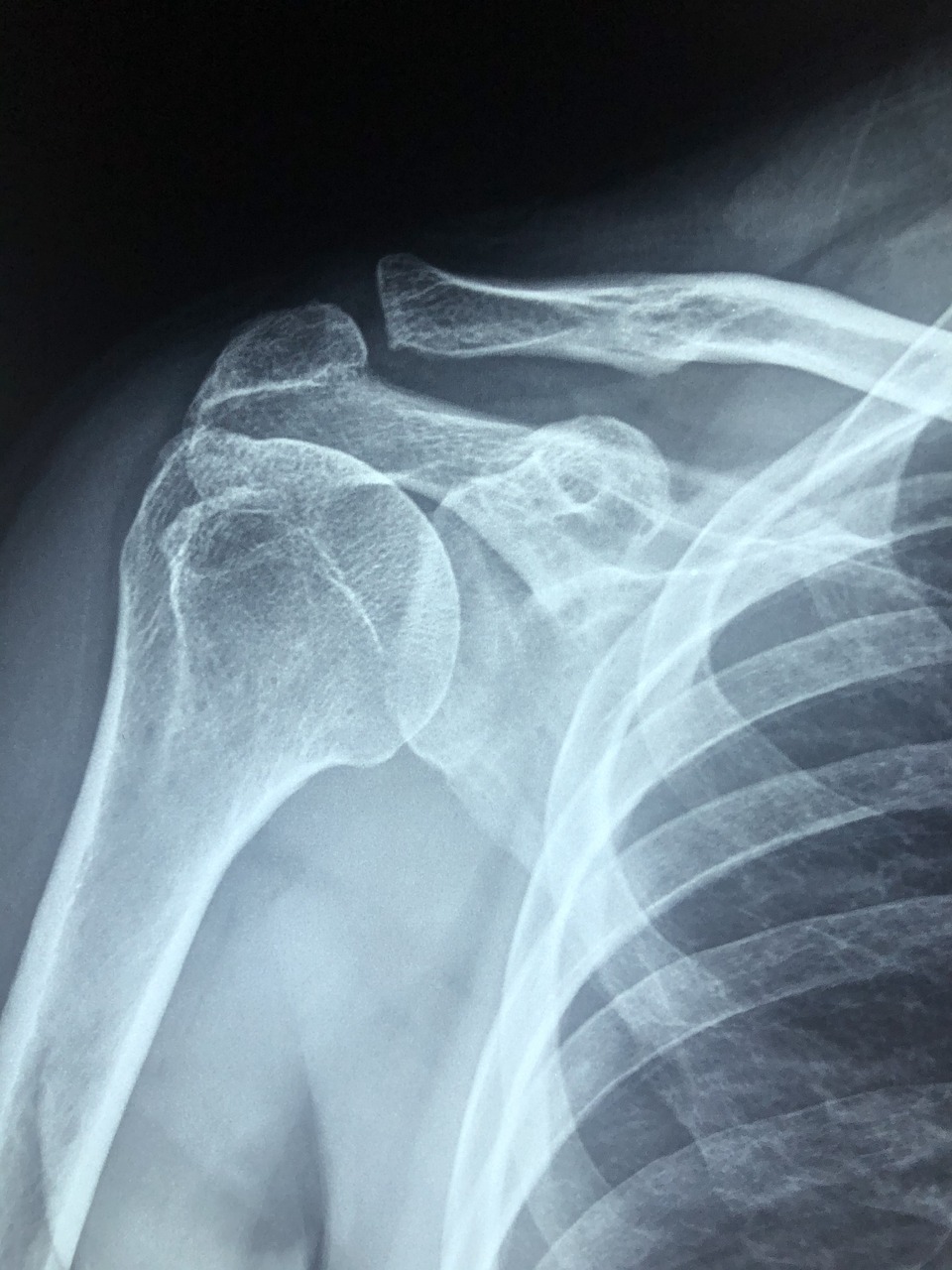 ≫tendinitis Calcificante En El Hombro Recupérate Ya